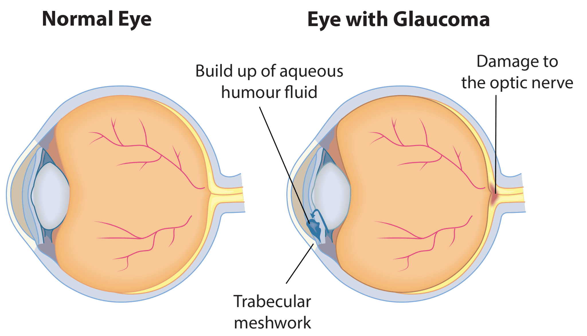 What is Glaucoma? - Chinese - Chelvin Sng Eye Center | Glaucoma ...