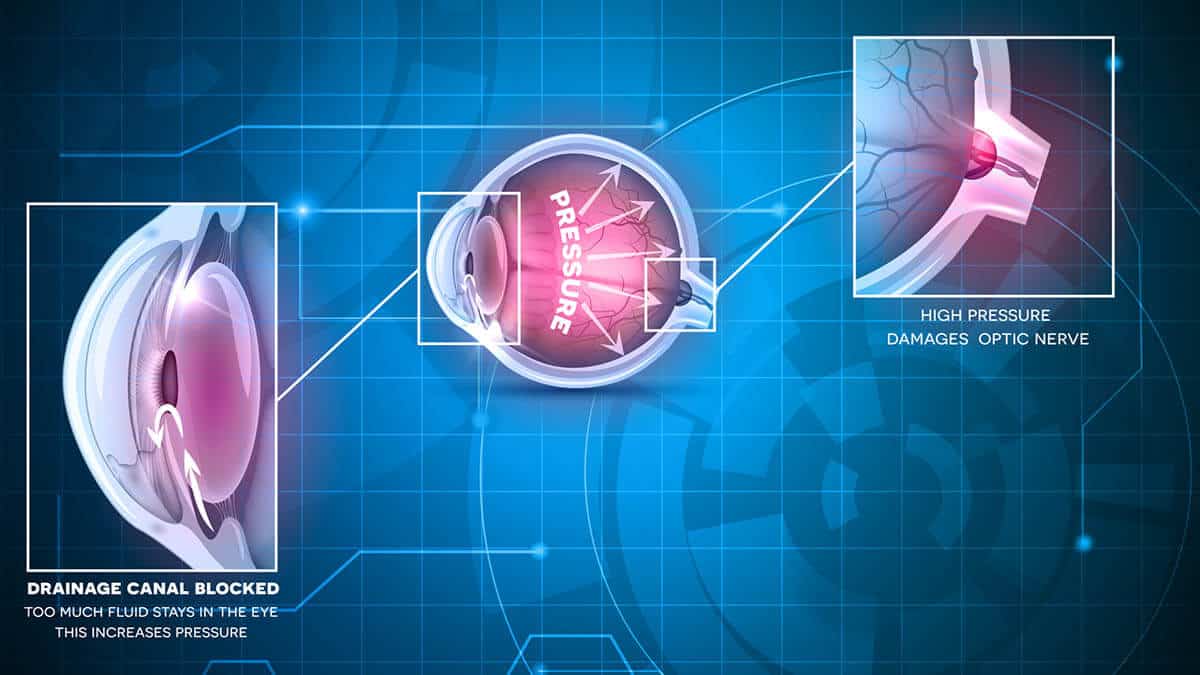What is Glaucoma? - Chelvin Sng Eye Center