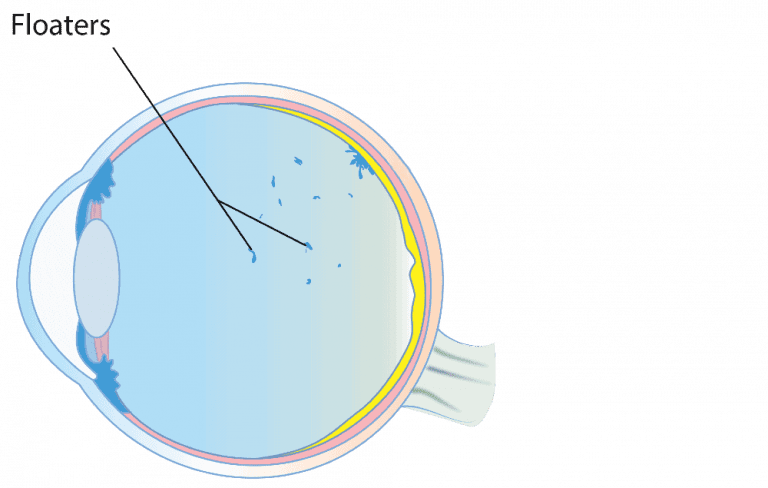 Floaters, Retinal Tears & Retinal Detachment Singapore | Dr Chelvin Sng