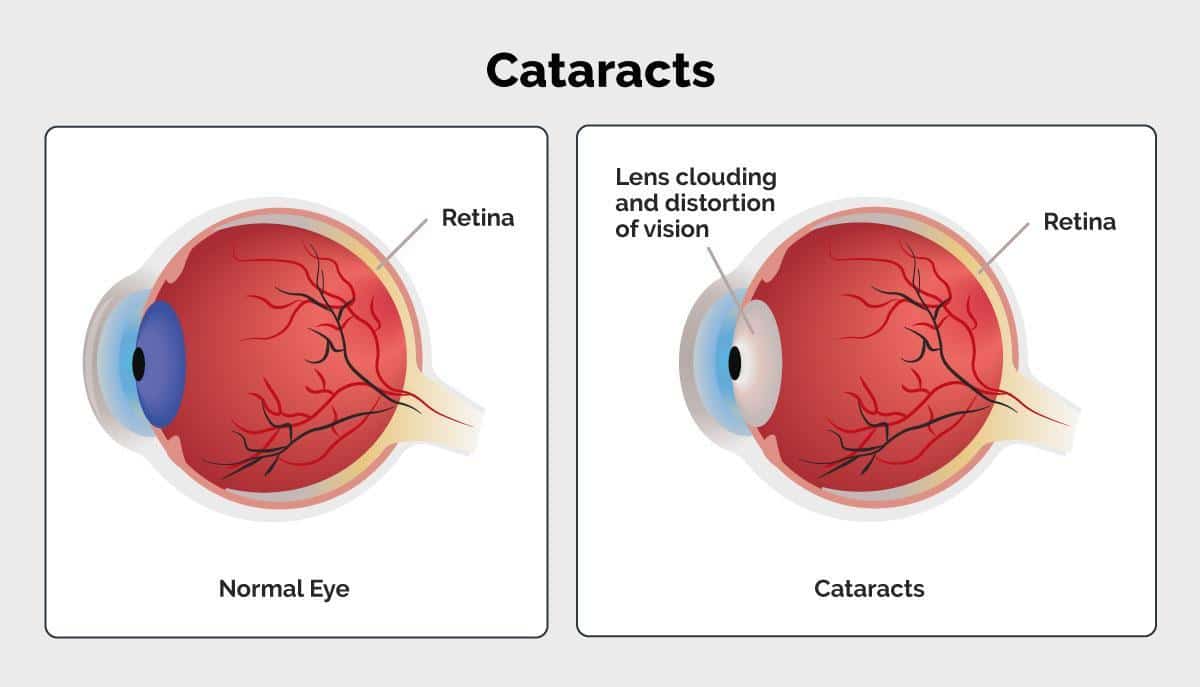 Glaucoma vs Cataracts: What’s the difference? - Chelvin Sng Eye Center ...
